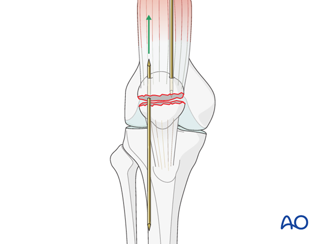 Tension band wiring for Complete articular, frontal/coronal simple ...