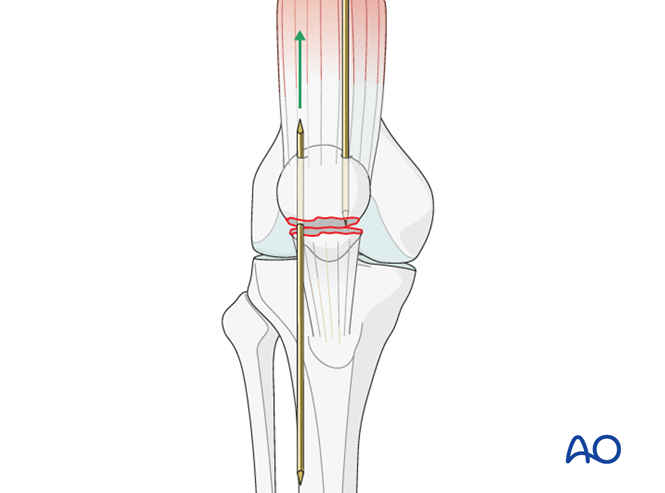 Tension band stitch for Complete articular, frontal/coronal simple ...