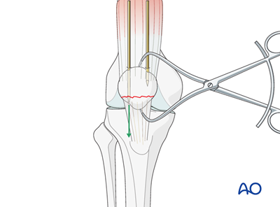 Tension band stitch for Complete articular, frontal/coronal simple ...