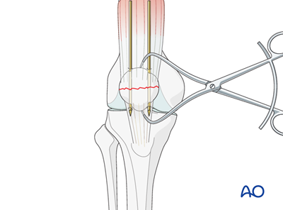 Tension band wiring for Complete articular, frontal/coronal simple ...