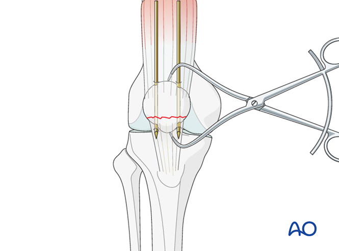 Cerclage compression suture for Complete articular, frontal/coronal ...