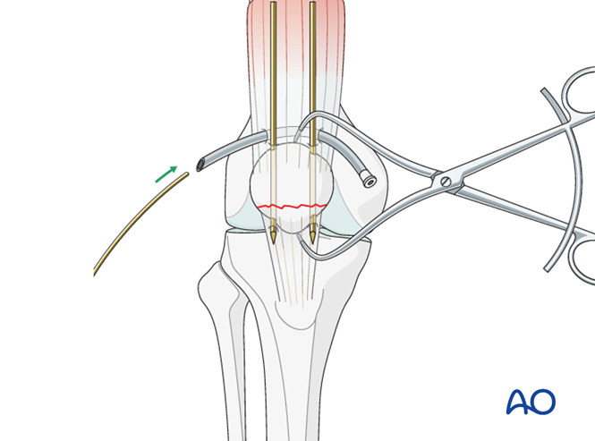 Tension band wiring for Complete articular, frontal/coronal simple ...