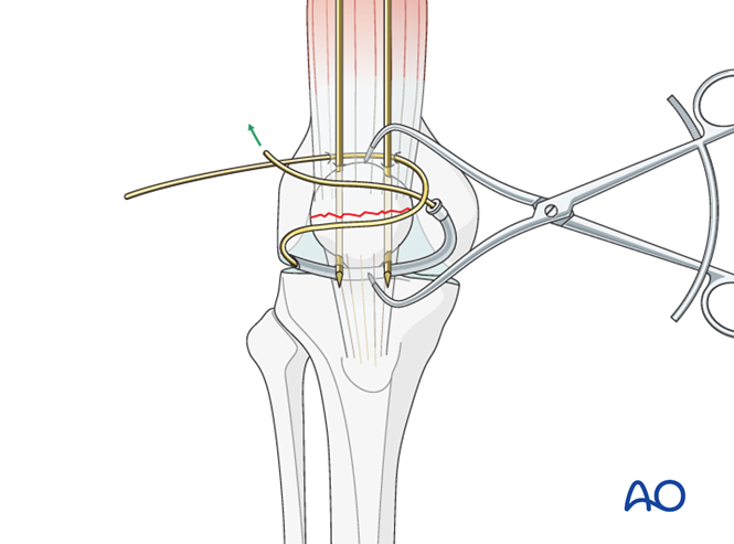 Tension band wiring for Complete articular, frontal/coronal simple ...