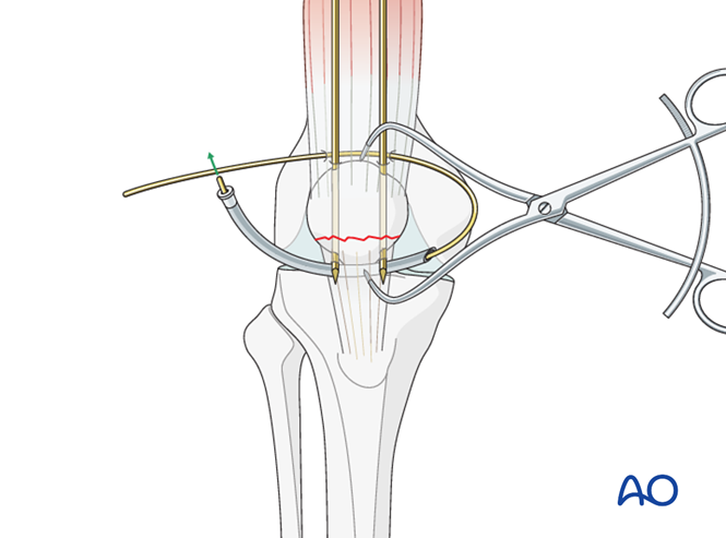 Cerclage compression wiring for Complete articular, frontal/coronal ...