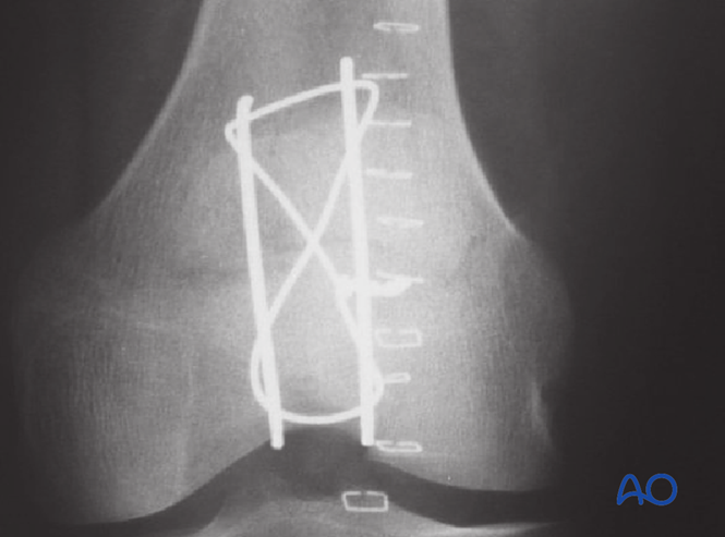 Cerclage compression wiring for Complete articular, frontal/coronal ...