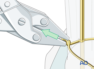 Tension band wiring for Complete articular, frontal/coronal simple ...