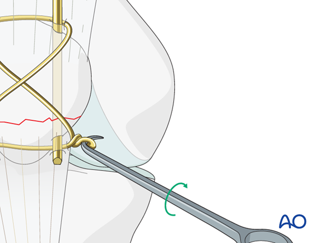 Tension band wiring for Complete articular, frontal/coronal simple ...