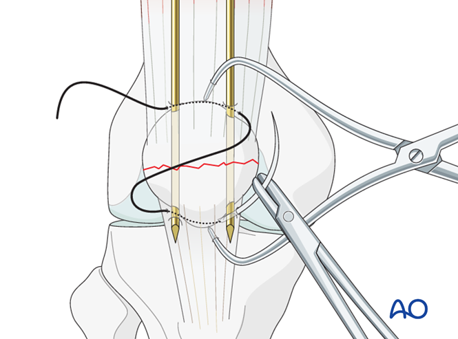 Tension band stitch for Complete articular, frontal/coronal simple ...