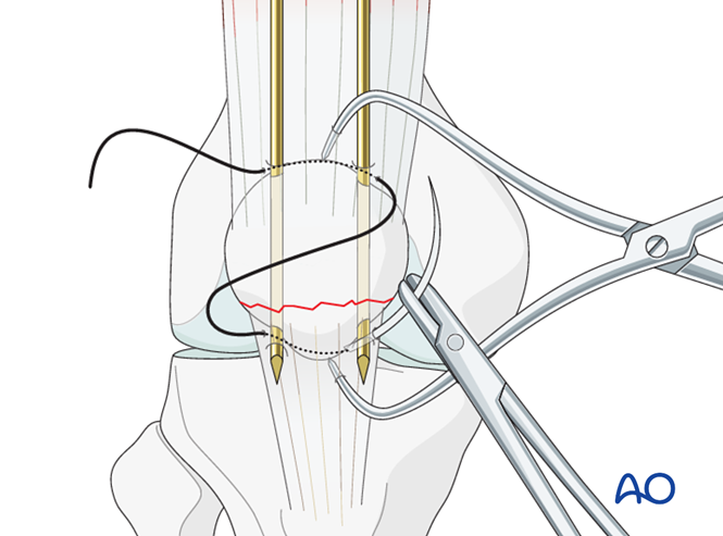 Cerclage compression suture for Complete articular, frontal/coronal ...