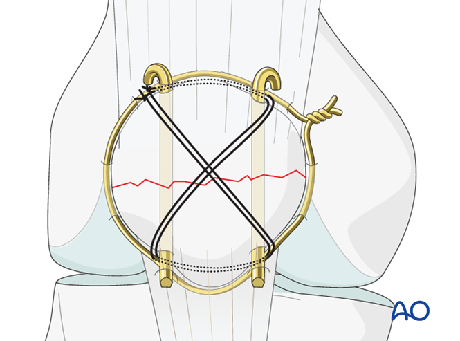 Cerclage compression suture for Complete articular, frontal/coronal ...