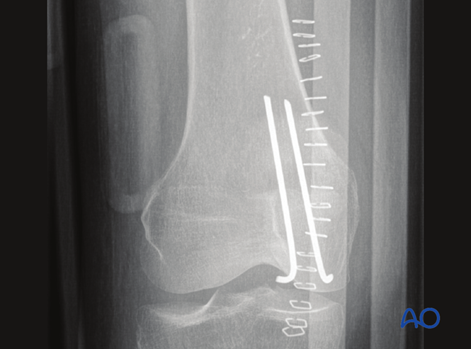 Tension band stitch for Complete articular, frontal/coronal simple ...