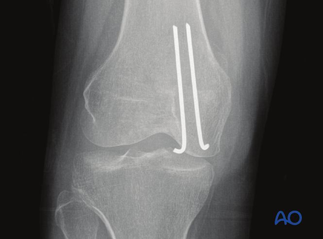 Tension band stitch for Complete articular, frontal/coronal simple ...