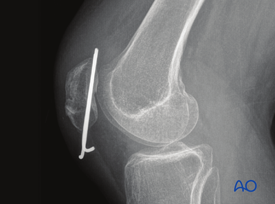 Tension band stitch for Complete articular, frontal/coronal simple ...