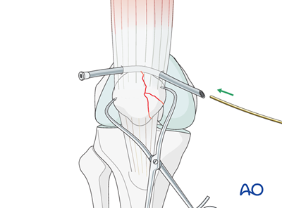 Cerclage wire for Partial articular, medial sagittal fragmentary fracture