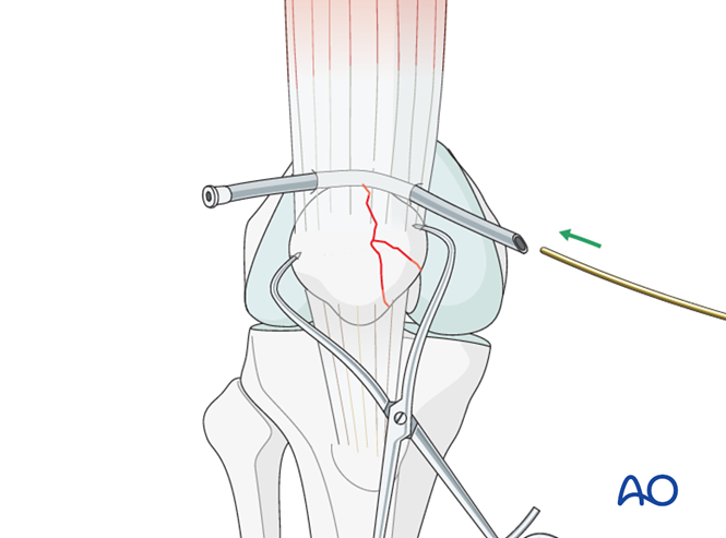 Cerclage wire for Partial articular, medial sagittal fragmentary fracture