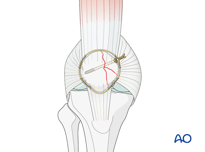 Cerclage wire for Partial articular, medial sagittal fragmentary fracture