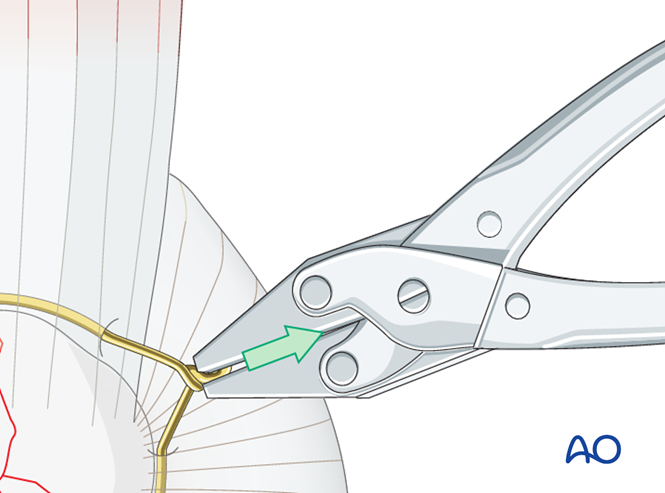 Cerclage wire for Partial articular, medial sagittal fragmentary fracture
