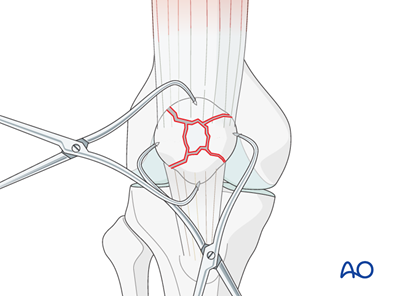 Cerclage wire for Complete articular, frontal/coronal multifragmentary ...