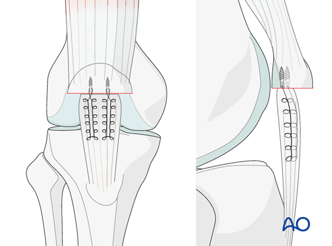 Salvage techniques for Complete articular, frontal/coronal wedge fracture