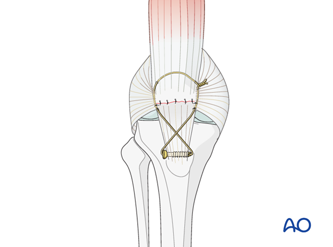 Salvage techniques for Complete articular, frontal/coronal wedge fracture