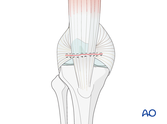 Salvage techniques for Complete articular, frontal/coronal wedge fracture