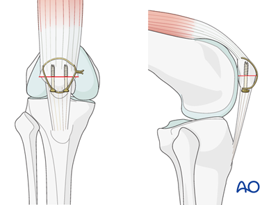 Salvage techniques for Complete articular, frontal/coronal wedge fracture