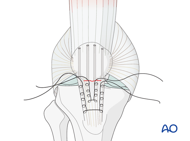 Suture repair for Extraarticular avulsion fracture