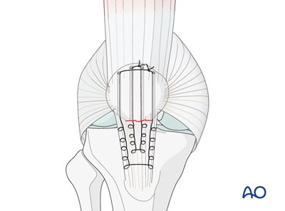 Suture repair for Extraarticular avulsion fracture