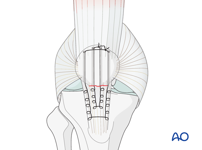 Suture repair for Extraarticular avulsion fracture