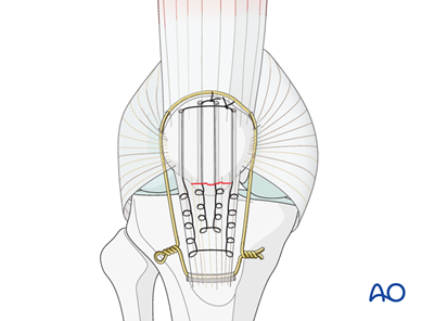 Suture repair for Extraarticular avulsion fracture