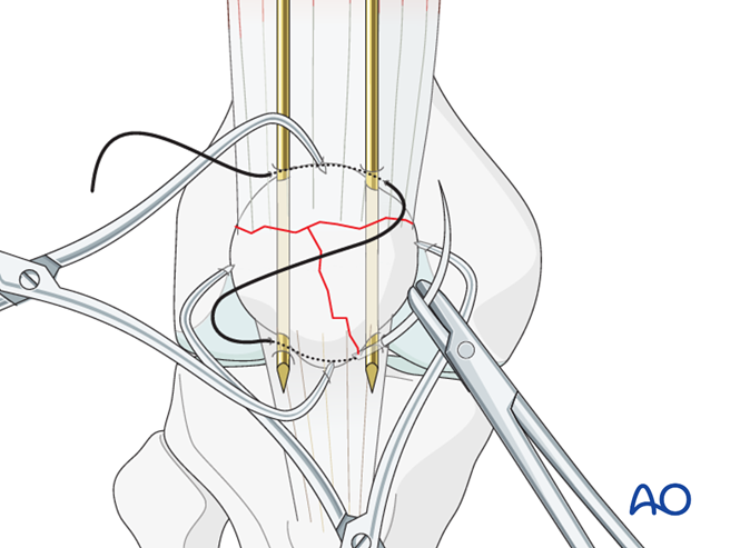 Cerclage compression suture for Complete articular, frontal/coronal ...