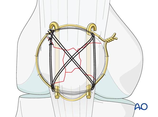 Cerclage compression suture for Complete articular, frontal/coronal ...