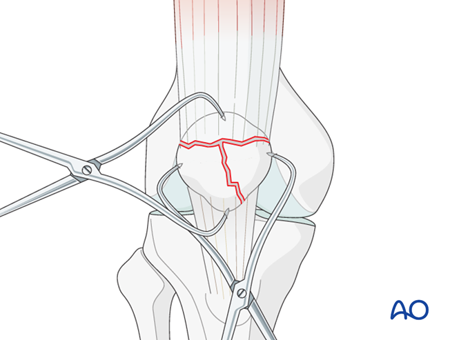 Patellar plating for Complete articular, frontal/coronal wedge fracture