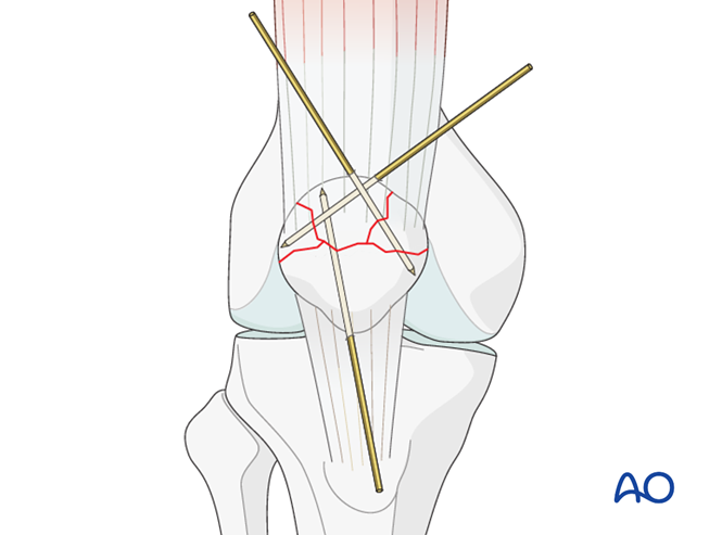 Patellar plating for Complete articular, frontal/coronal ...