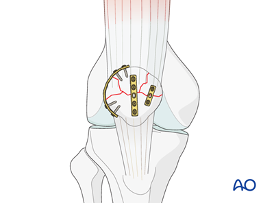 Patellar plating for Complete articular, frontal/coronal ...