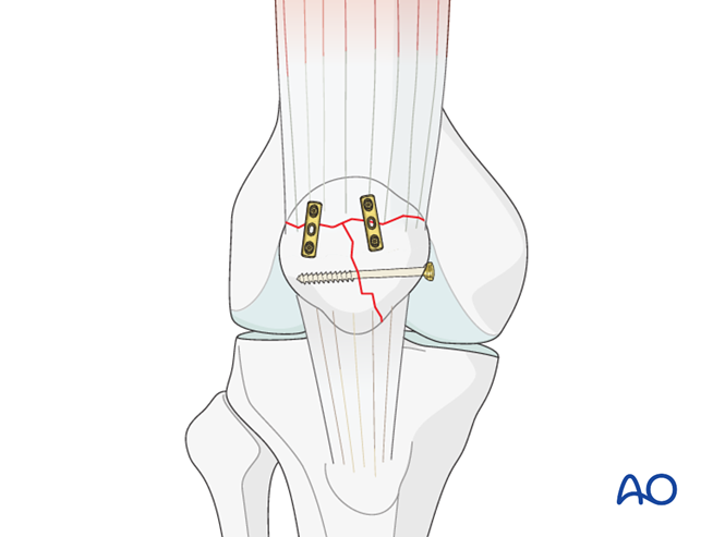 Patellar plating for Complete articular, frontal/coronal wedge fracture