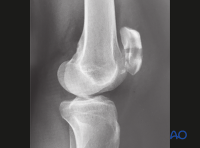 Patellar plating for Complete articular, frontal/coronal ...