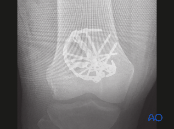 Patellar plating for Complete articular, frontal/coronal ...