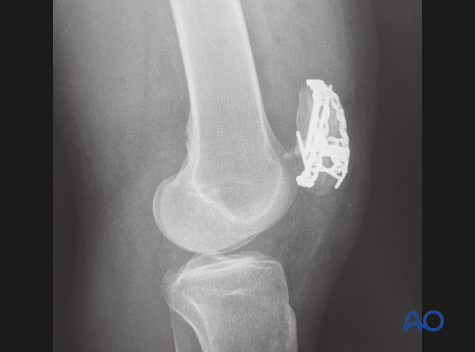 Patellar plating for Complete articular, frontal/coronal ...