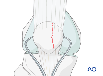 Suture anchors for Partial articular, medial sagittal simple fracture