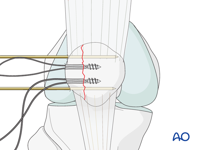 Suture anchors for Partial articular, lateral sagittal simple fracture