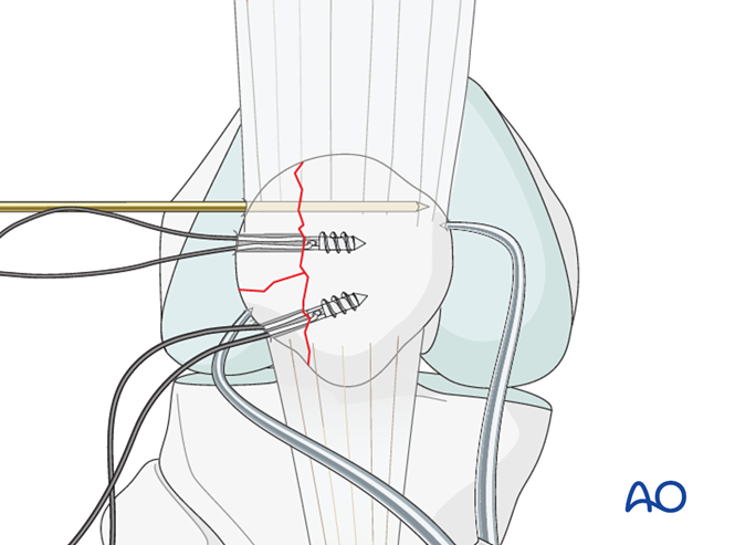 Suture anchors for Partial articular, lateral sagittal fragmentary fracture