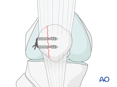 Suture anchors for Partial articular, lateral sagittal simple fracture