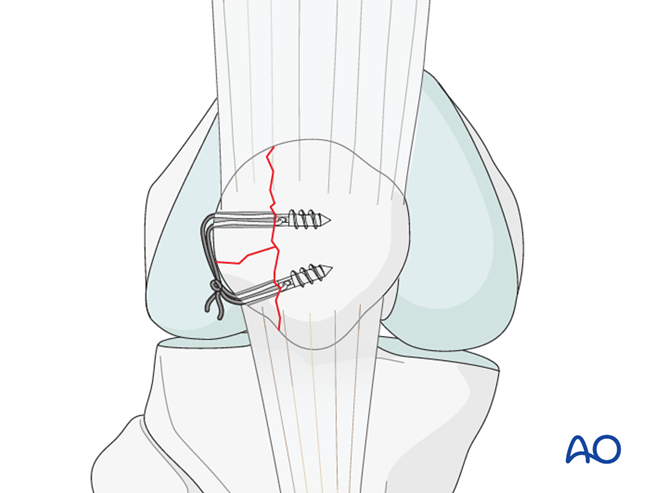 Suture anchors for Partial articular, lateral sagittal fragmentary fracture
