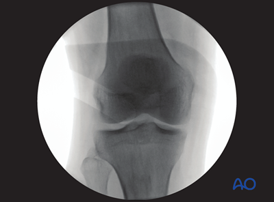 Intraoperative imaging of the patella