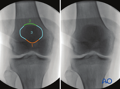 Intraoperative imaging of the patella