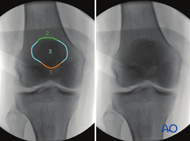 Intraoperative imaging of the patella
