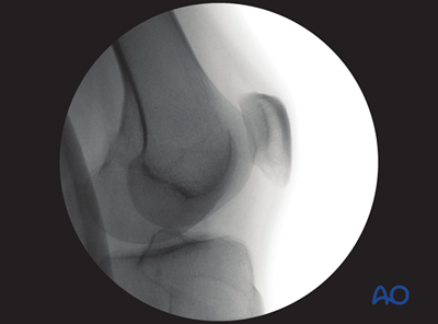 Intraoperative imaging of the patella