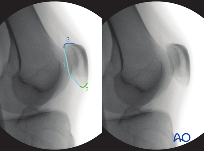 Intraoperative imaging of the patella