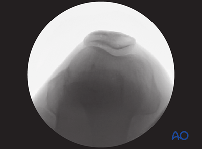Intraoperative imaging of the patella